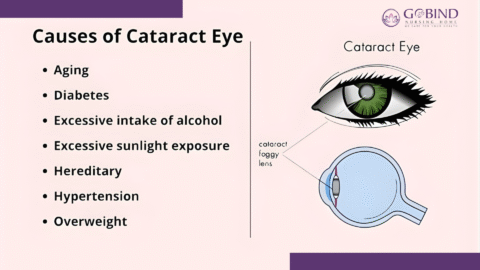 What Is Phacoemulsification? A Complete Guide - Cataract Surgery